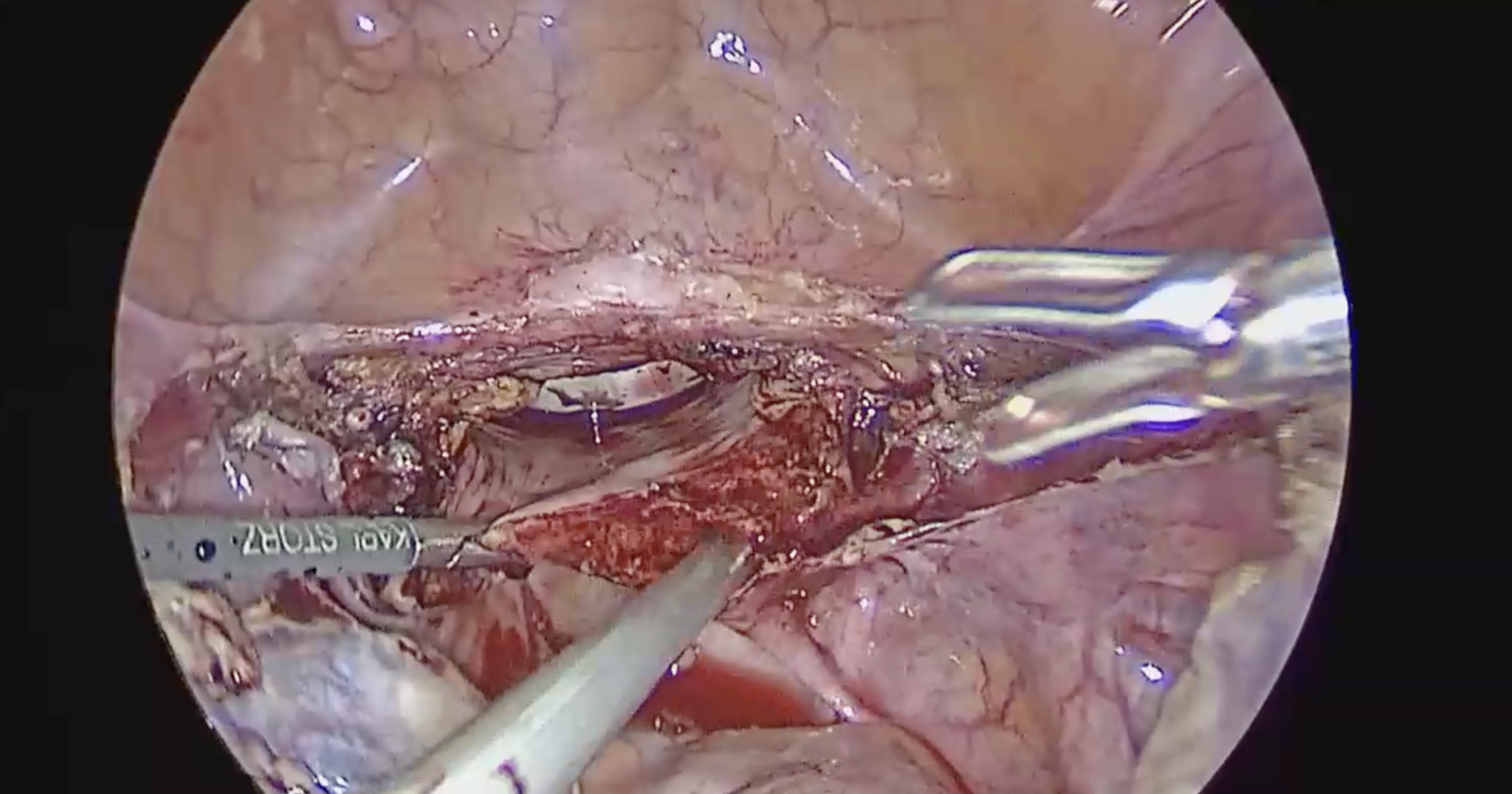 Surgical Spotlight Robotic Vs Laparoscopic Hysterectomy Theator The Surgical Intelligence